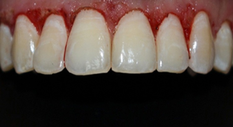 Imágenes de Tratamientos - Periodoncia e Implantes dentales Dra Johanna ...